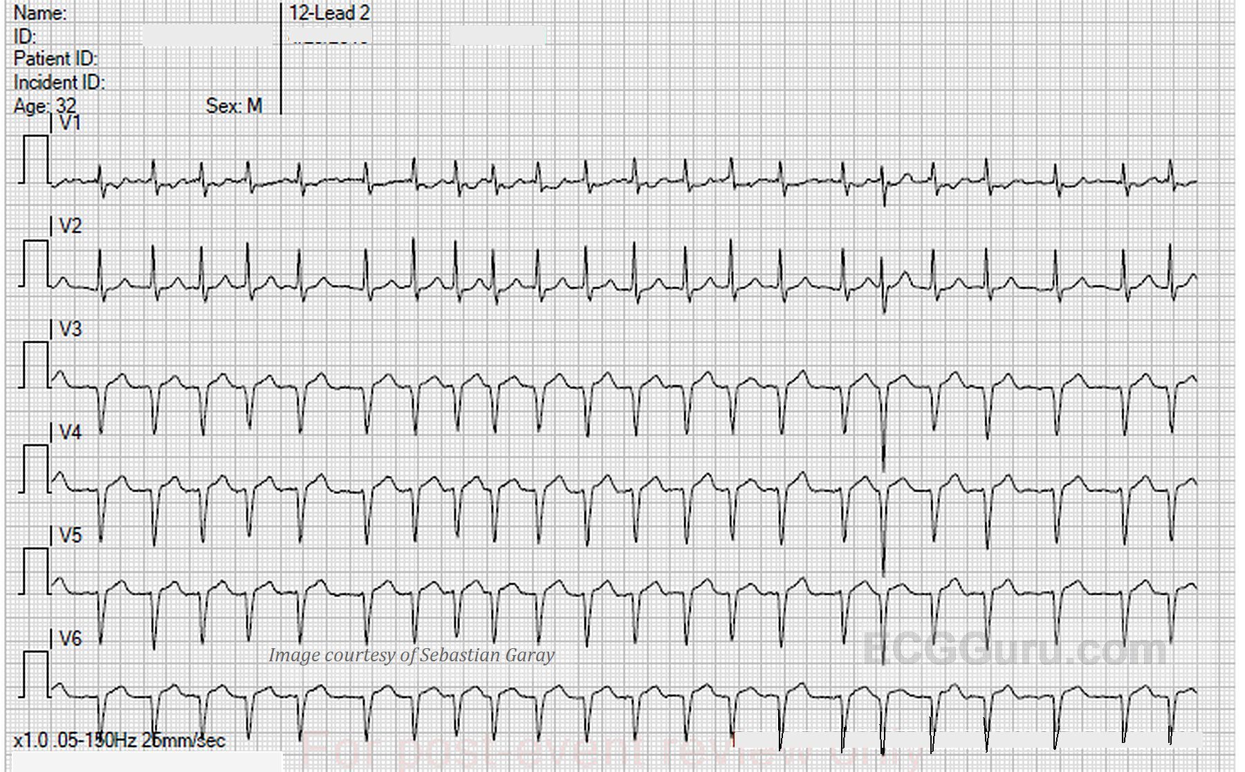 Atrial Fibrillation And Type 2 M I Ecg Guru Instructor Resources